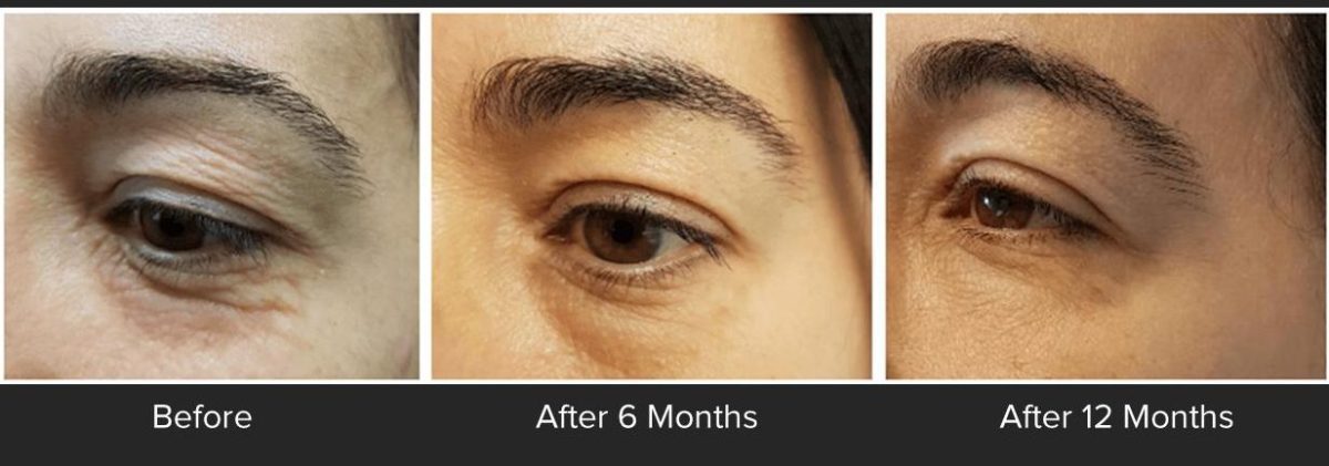 Attiva RF Skin Tightening & Contouring in Dubai